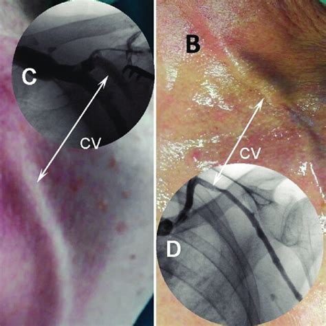 The Infraclavicular And Supraclavicular Position Of The Cephalic Vein Download Scientific