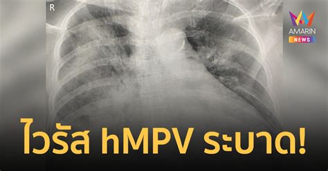 Beware Of Hmpv Virus Symptoms Outbreak And Treatment Updated Information 2023 Archyde