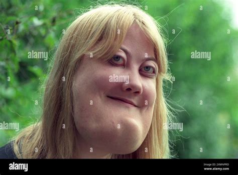 A Young Woman With Cherubism The Rare Genetic Condition Is A