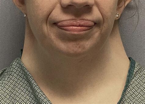 Female Webbed Neck Front 1a Dr Barry Eppley Explore Plastic Surgery