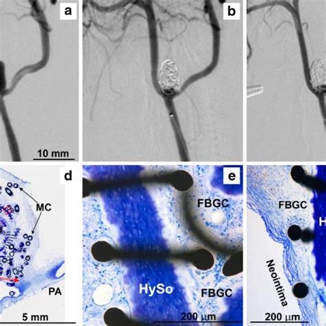 Aneurysm Treated With Hydrocoil Devices A Pre Embolization Dsa