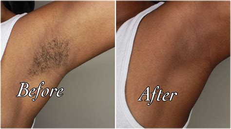 Underarm Waxing Before And After