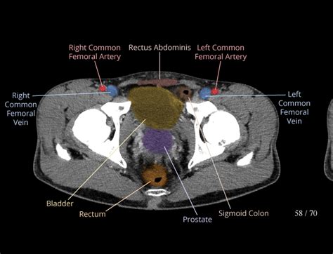 Labelled Female Ct Scan Abdomen At Faith Sager Blog