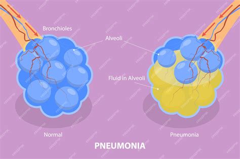 폐렴 폐 감염의 D 등각 투영 평면 벡터 일러스트 레이 션 프리미엄 벡터