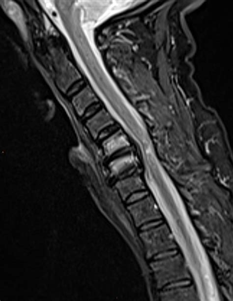 Disc Protrusion Zones At Ronald Wray Blog