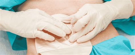 What Is A Urostomy Types Of Urostomies