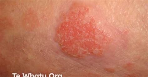 Plaque Stage Mycosis Fungoides Image