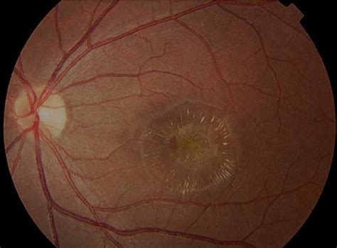 Choroidal Neovascularization Semantic Scholar