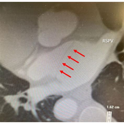 Multidetector Computed Tomography Angiography Confirming The Presence Download Scientific