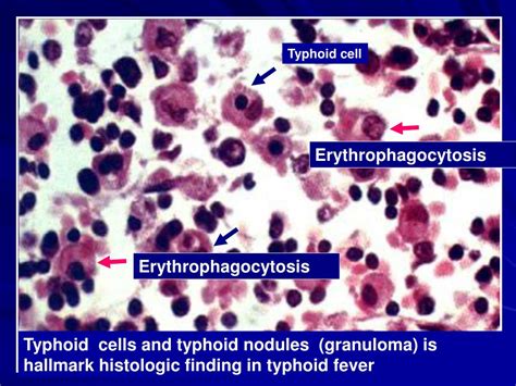 Ppt Infectious Disease Intestinal Disease Page 446 Powerpoint
