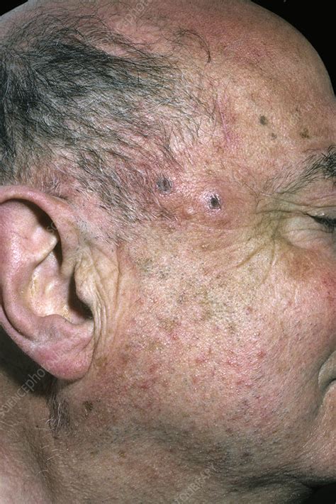 Temporal Arteritis Stock Image C Science Photo Library