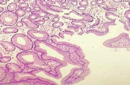 Portal Hypertensive Gastropathy Foveolar Hyperplasia Regeneration
