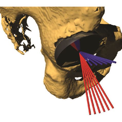 Solid Modeling Of Pelvis Cup And Vectors Generated By Changing Pelvic Download Scientific