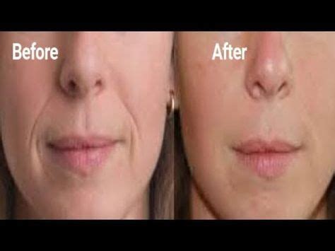Rapidly Remove Deep Smile Lines Fast Look Younger And With This Wrinkle