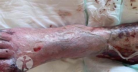 Purpura Fulminans Image