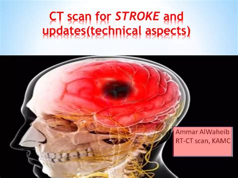 Ct Scan Of The Brain In Stroke Patients Pptx