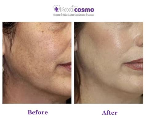 Reveal Your Radiant Skin With Body Polishing At Rootcosmo
