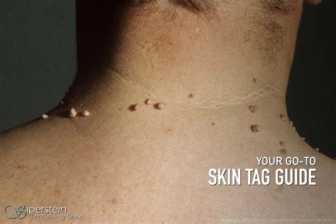 Skin Tags On Neck Dessiccation — Neoderma Advanced Skin Care