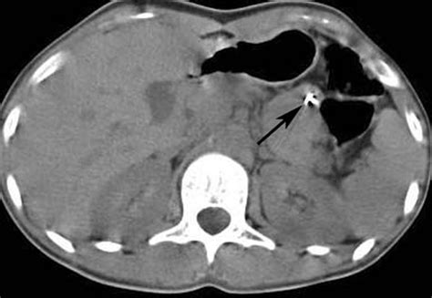 Axial Non Enhanced Ct Scan Showed Hyperdensity Due To Metallic Sewing Download Scientific