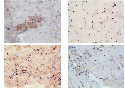 Immunohistochemical Staining Of Ctgf And Tgf β1 Magnification X100