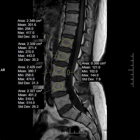 Sex Differences In The Accuracy Of Vertebral Bone Quality Score