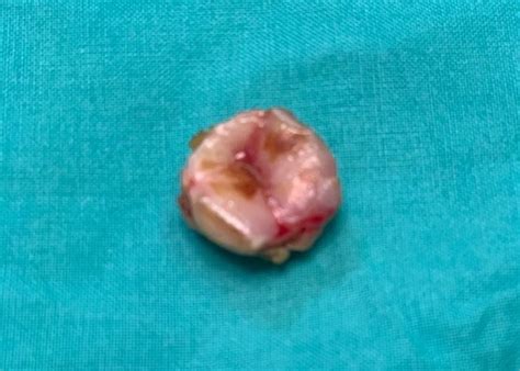 Lletz Procedure What To Expect And Aftercare