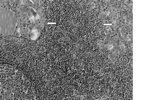 Close Up View Of The Non Tumoral Thyroid Parenchyma Showing Germinal Download Scientific
