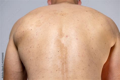 Tinea Versicolor On The Back Pityriasis Versicolor Problem With Skin