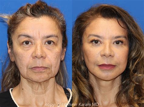 Facial Plastic Surgery Before After Photos Carmel Valley Plastic