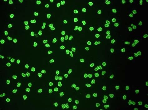 Less Frequent Andor Rare Nuclear Patterns A Multiple Nuclear Dots
