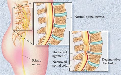 Nonsurgical Treatment Options For Lumbar Spinal Stenosis Mayo Clinic