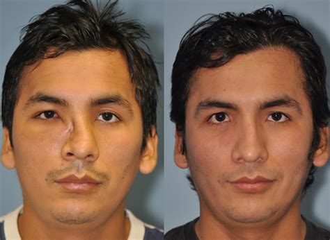 Nasal Septum Deviation Surgery