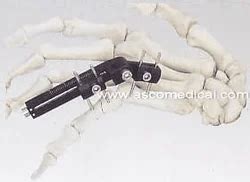 External Fixators Instruments For Unilateral Multi Function External