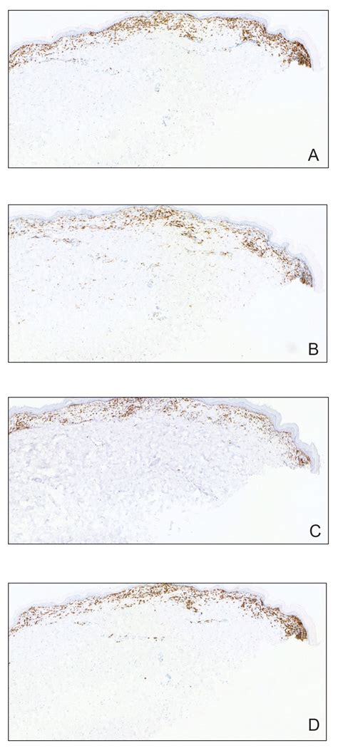 White Spots On The Extremities Mdedge