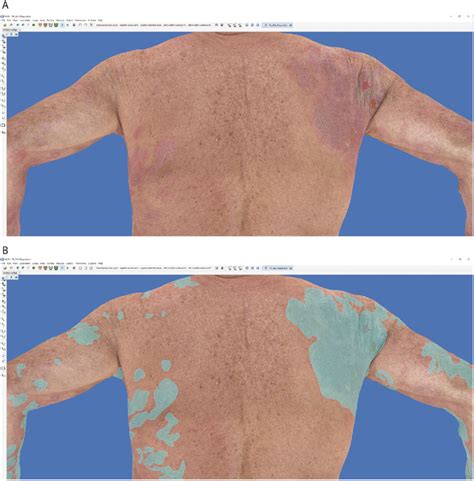 Sample Photographs Of A Patient With Cutaneous Lymphoma In Vectra Download Scientific Diagram
