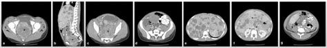 Axial Ct Scan Image Shows A Large Ill Defined Heterogeneous Solid Download Scientific Diagram