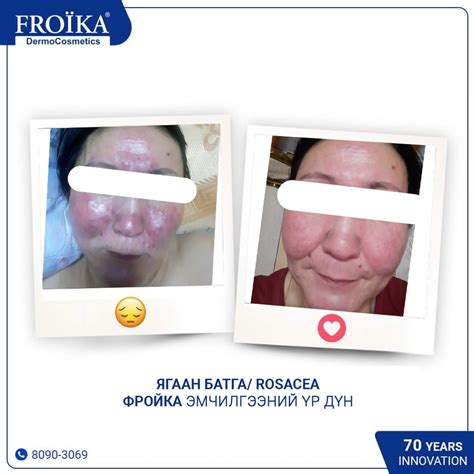 Froika Mongolia ЯГААН БАТГА розацея эрвээхэй 🦋 Facebook