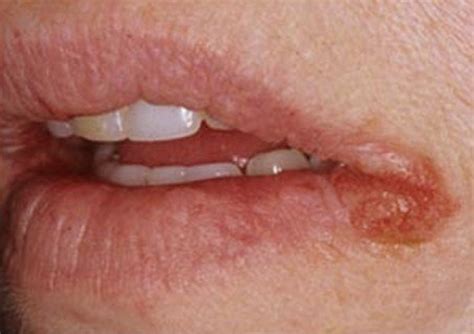 Mild Angular Cheilitis Treatment