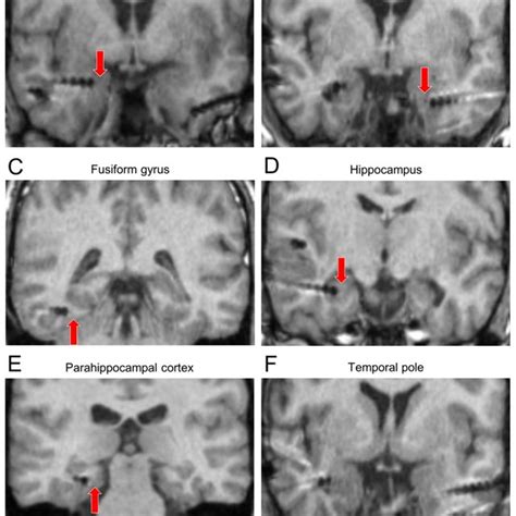 Fig S1 Examples Of Microelectrode Locations A F Example Download Scientific Diagram