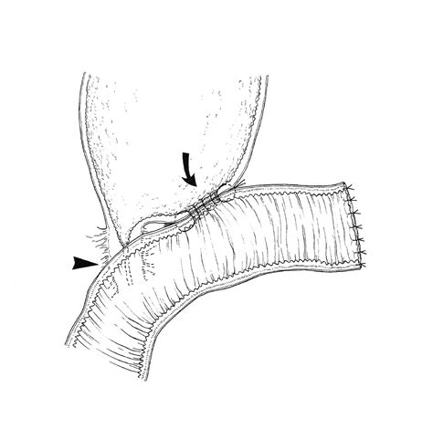 Revision Skip Hepaticojejunostomy For Refractory Benign Hepaticojejunostomy Strictures
