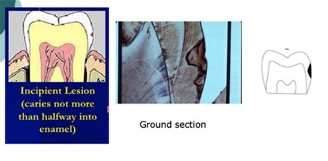 Bitewing Radiographs Diagnosis Of Caries Flashcards Quizlet