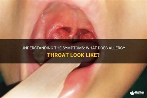 Understanding The Symptoms What Does Allergy Throat Look Like Medshun