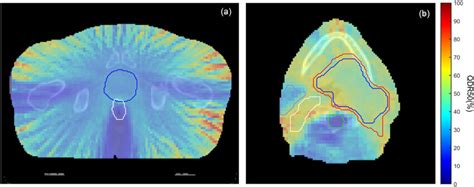 Relative Qdr50 Values Superimposed On Corresponding Axial Ct Slices