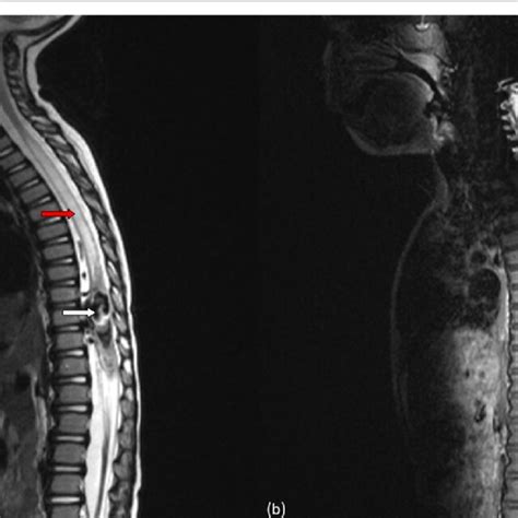 A T2 Weighted And B T1 Weighted Post Contrast Sagittal Magnetic
