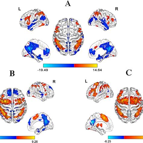 Significant Deactivated Regions During 2 Back Working Memory Task In
