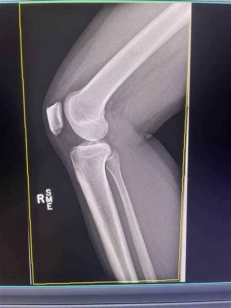 Lateral Knees Are So Satisfying Rradiology