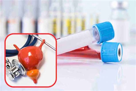 Test Fai Da Te O Esami Dal Sangue Cos Meglio Fare Per Scoprire Il Tumore Alla Prostata