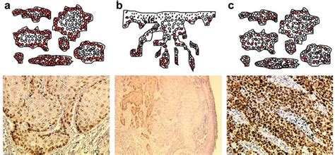 P53 Staining Patterns A Staining In The Basal Parts Of Infiltrating Download Scientific