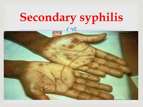 Ppt Syphilis Basics Powerpoint Presentation Free Download Id1890319