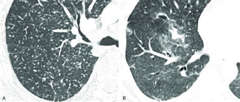 Example Of Ct Interpretation Of Miliary Nodules A Miliary Nodule Download Scientific Diagram